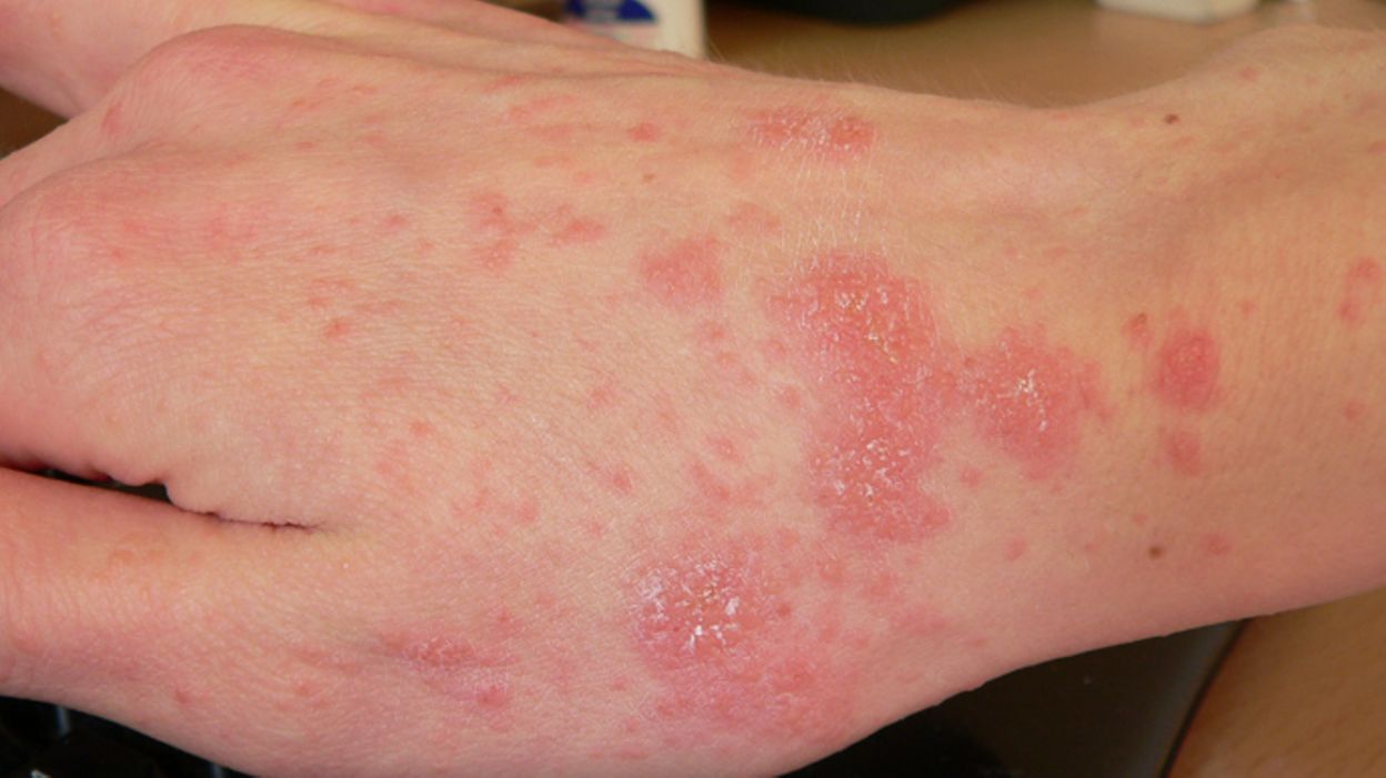 Plusieurs cas de gale norvégienne détectés chez des sans-abri à Liège