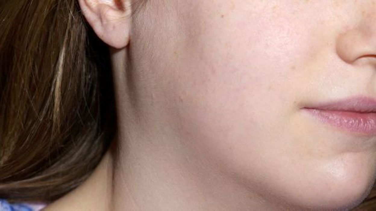 Le virus des oreillons s'étend en Flandre