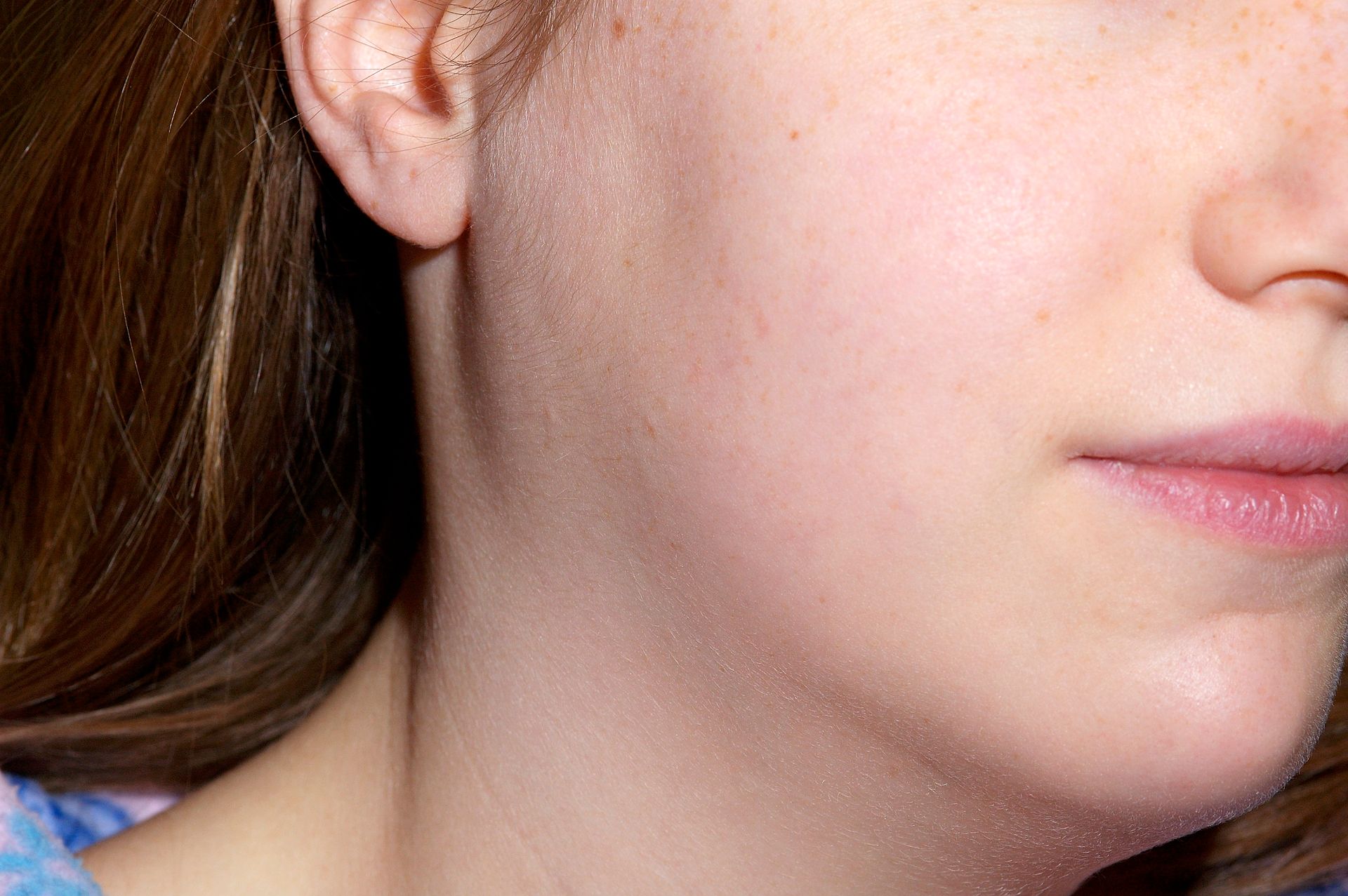 Le virus des oreillons s'étend en Flandre