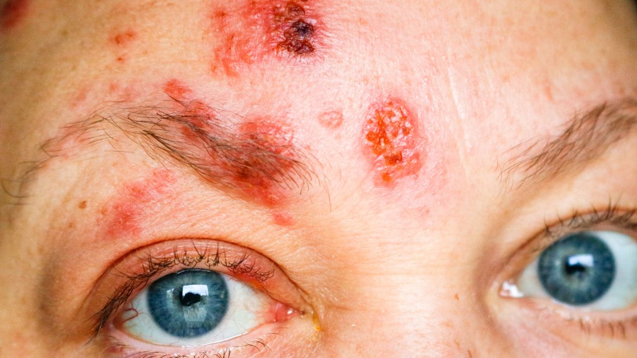 Le CSS recommande la vaccination contre le zona pour les 60 ans et plus ...